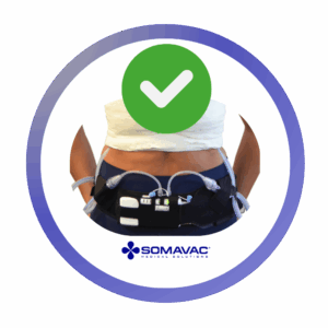 Simplify Recovery: SOMAVAC® Post-Surgical Drain System